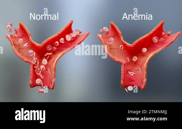Anemia amount of blood cell or hemoglobin and normal. Aplastic anemia ...