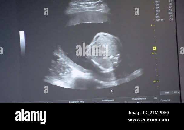 Ultrasound on monitor. Ultrasound image on computer monitor screen ...