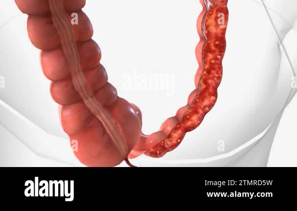 Ulcerative colitis is an inflammatory bowel disease that causes ...