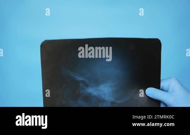 Trauma brain x ray Stock Videos & Footage - HD and 4K Video Clips - Alamy
