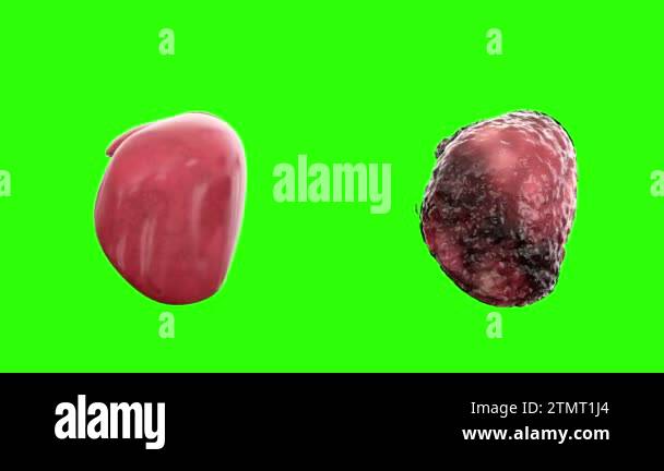 healthy liver and disease liver on green screen rotate. Autopsy medical ...