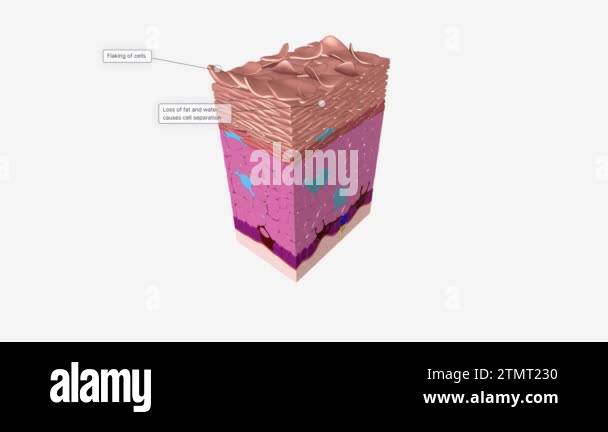 Dry Skin In Epidermis The Stratum Corneum Is The Outermost Layer Of The