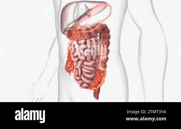 Inflammatory bowel disease ibd Stock Videos & Footage - HD and 4K Video ...