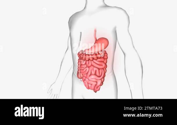 Gastroenteritis is an inflammation of the lining of the stomach and ...