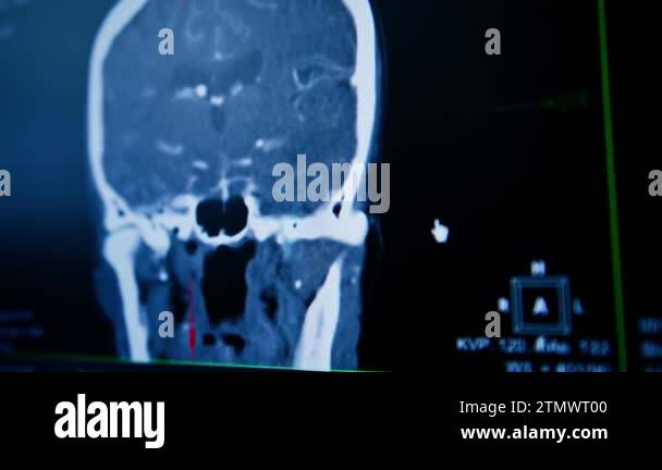 computer tomography brain 3d rendering image on screen brain ...