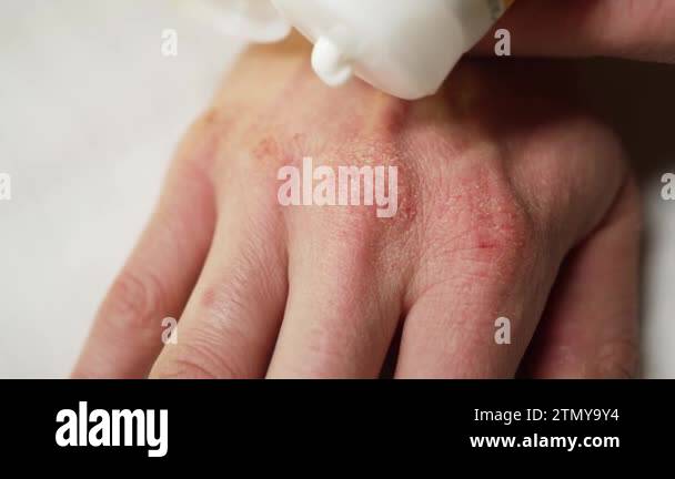 Man applies a moisturizer on a cracked hand close-up, treatment of skin ...