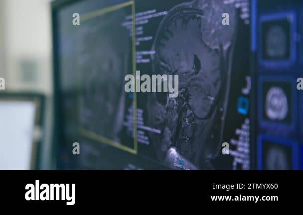 Brain computed tomography tumor 3d Stock Videos & Footage - HD and 4K ...