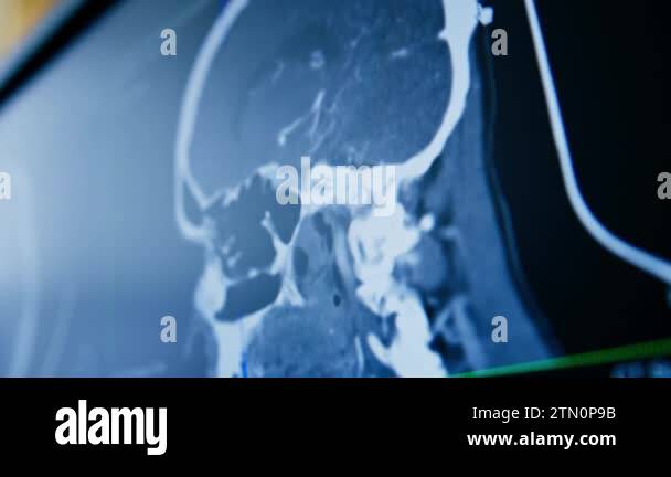 computer tomography brain 3d rendering image on screen brain ...