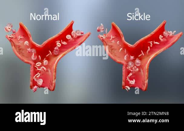 Sickle cell anemia disease, medically accurate 3d animation of ...
