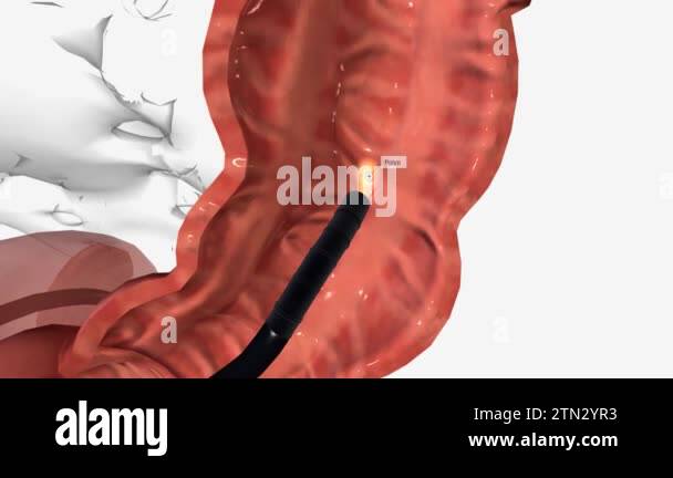 A colonoscopy can help your doctor explore possible causes of abdominal ...