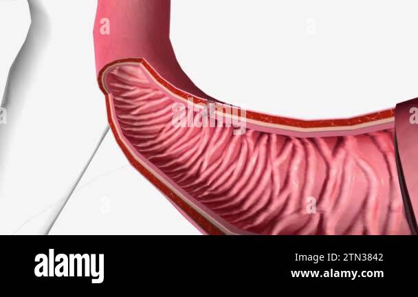Duodenal Carcinoma Stage 2 Cancer cells exist in the duodenum and now ...