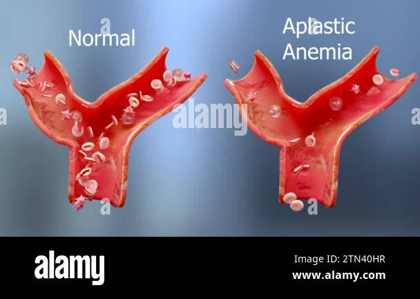 Anemia amount of blood cell or hemoglobin and normal. Aplastic anemia ...