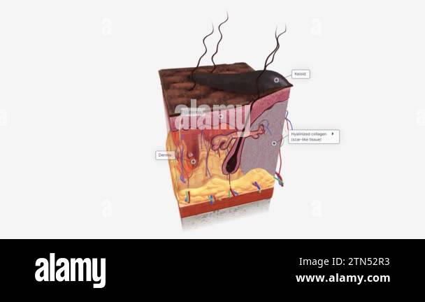 Keloids in Skin Tissue A keloid scar is a thick raised scar Stock Video ...