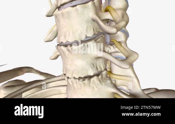 Bone spurs, or osteophytes, are bony growths that form in your joints ...