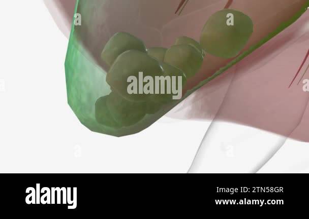 Cholelithiasis or gallstones are hardened deposits of digestive fluid ...