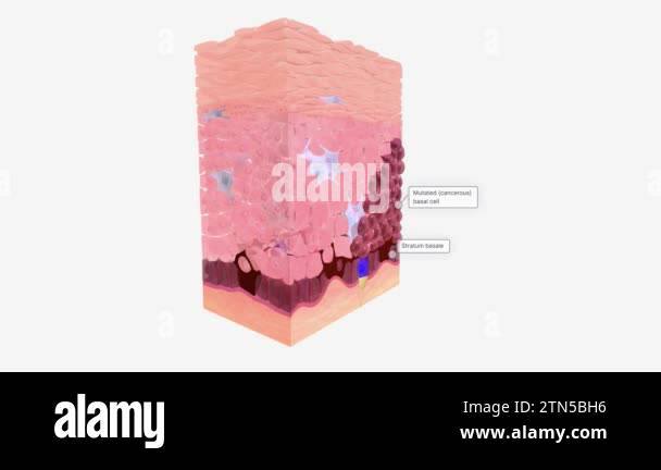Basal Cell Carcinoma in Tissue, Stage 0 Stock Video Footage - Alamy