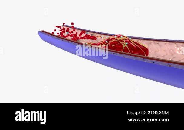 A blood clot in a deep vein of the leg, pelvis, and sometimes arm, is ...