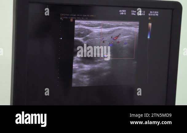 Ultrasonic diagnostics. Ultrasound monitor. Monitor with ultrasonic ...