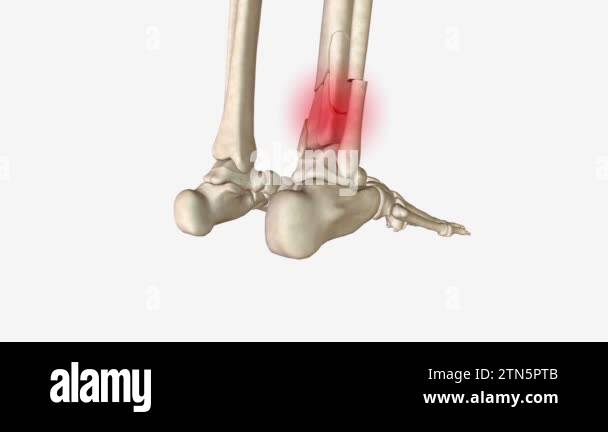 Distal tibia fracture is a fracture that involves the metaphyseal area ...