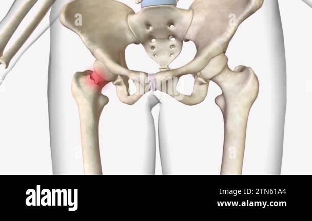 Femoral neck fractures are a specific type of intracapsular hip ...