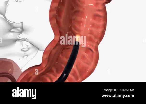 A colonoscopy can help your doctor explore possible causes of abdominal ...