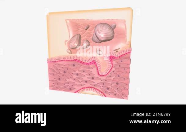 Benign Prostatic Hyperplasia in Prostatic Tissue Stock Video Footage ...