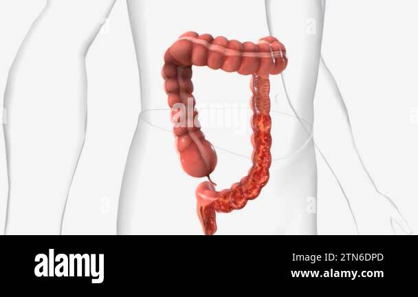 Ulcerative Colitis Is An Inflammatory Bowel Disease That Causes