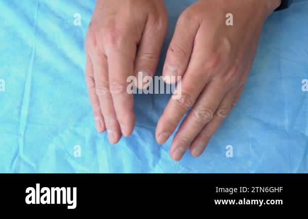 Man showing affected hands close up. Hand rash eczema or contact ...