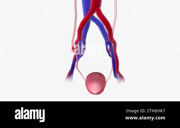 Kidney stones (also called renal calculi, nephrolithiasis or ...