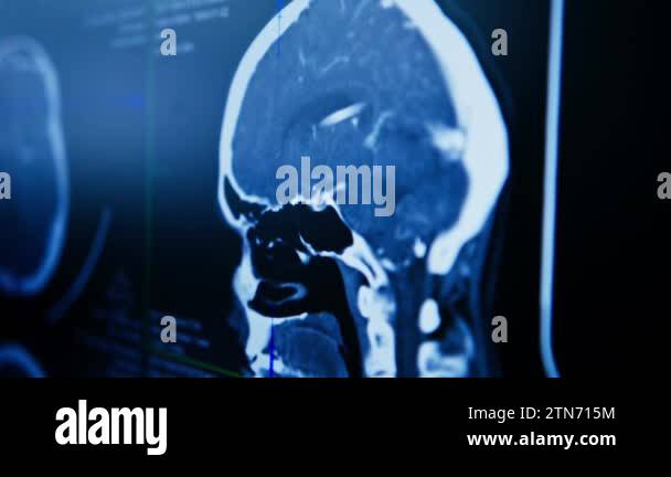 computer tomography brain 3d rendering image on screen brain ...