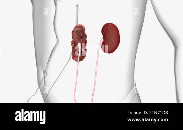 Polycystic kidney disease is a disease in which clusters of cysts ...