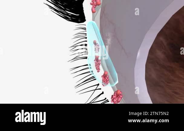 People with blepharitis may experience a gritty or burning sensation in ...