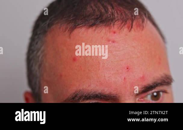 Man's forehead with acne, red spots, skin disease. Varicella or Herpes Zoster concept Stock ...