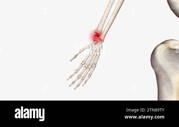 Distal radius fractures are the most common orthopaedic injury and ...
