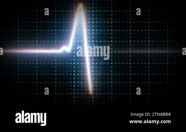 Sinus Heart Rhythm On Electrocardiogram Record Paper Showing Normal P ...
