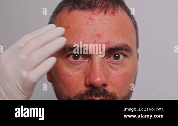 Man's forehead with acne, red spots, skin disease. Varicella or Herpes Zoster concept Stock ...