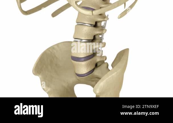 Spinal fixation system - titanium bracket. Medically accurate tooth 3D ...