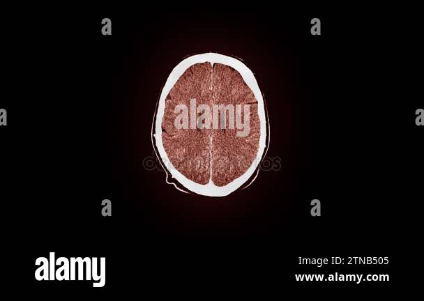 Mri of brain frontal lobe Stock Videos & Footage - HD and 4K Video ...