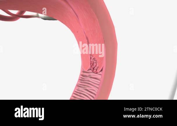 Cervical lining Stock Videos & Footage - HD and 4K Video Clips - Alamy