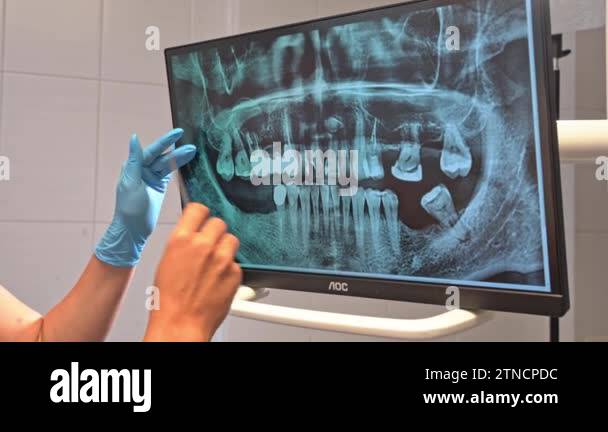 Dentist hand explore study teeth mouth cavity x-ray on monitor describe ...