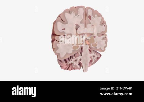 Neurological lesions Stock Videos & Footage - HD and 4K Video Clips - Alamy