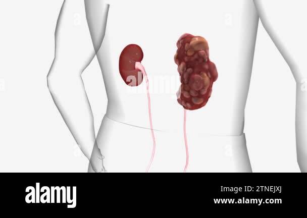 Polycystic kidney disease is a disease in which clusters of cysts ...