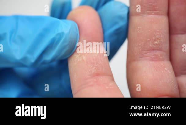 Peeling of palms and fingers of allergy. Fingers of a man with eczema ...