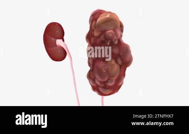 Polycystic kidney disease is a disease in which clusters of cysts ...