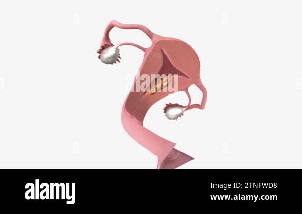 Stage II endometrial cancer shown in a cross-section drawing of the ...