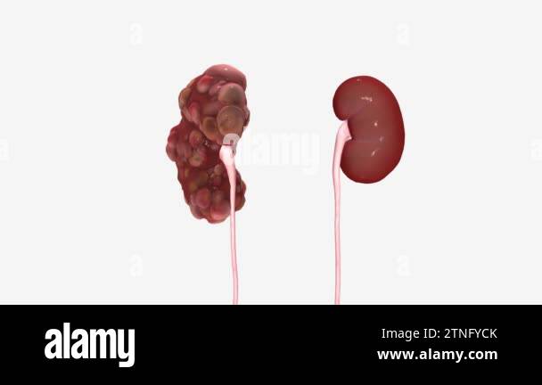 Polycystic kidney disease is a disease in which clusters of cysts ...