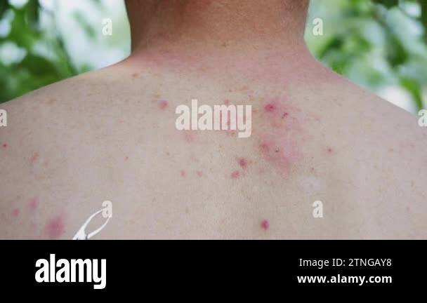 The process of extracting bee sting from the human body. Bee stings for ...