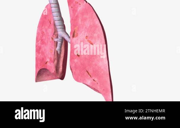 Lungs Coronal Cross Section Left inferior lobe Stock Video Footage - Alamy