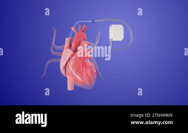 Artificial cardiac Stock Videos & Footage - HD and 4K Video Clips - Alamy