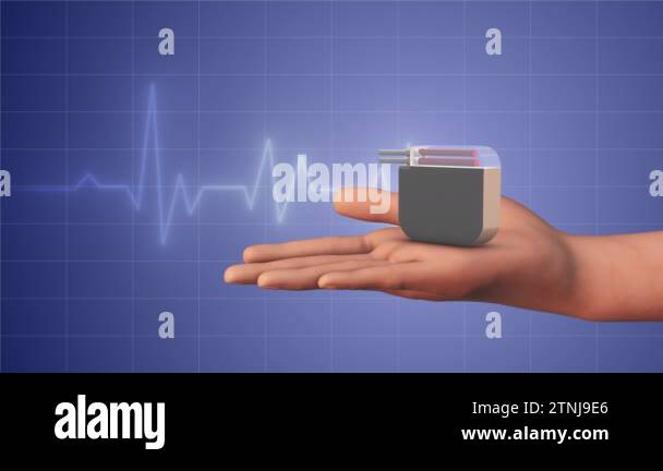 Heart pacemaker in hand Stock Videos & Footage - HD and 4K Video Clips ...